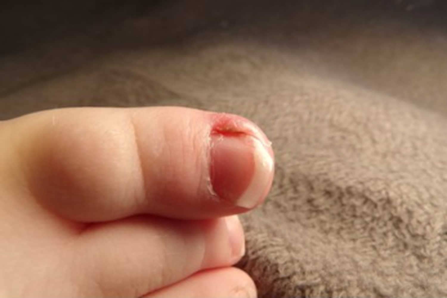 Ingrown toenails in babies – Causes, Symptoms and Treatment - Being The ...