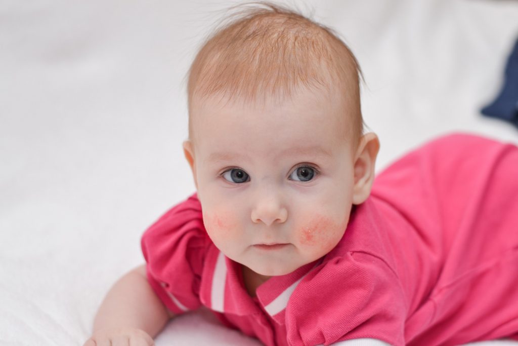 8 Common Skin Problems in Babies and Their Solutions - Being The Parent