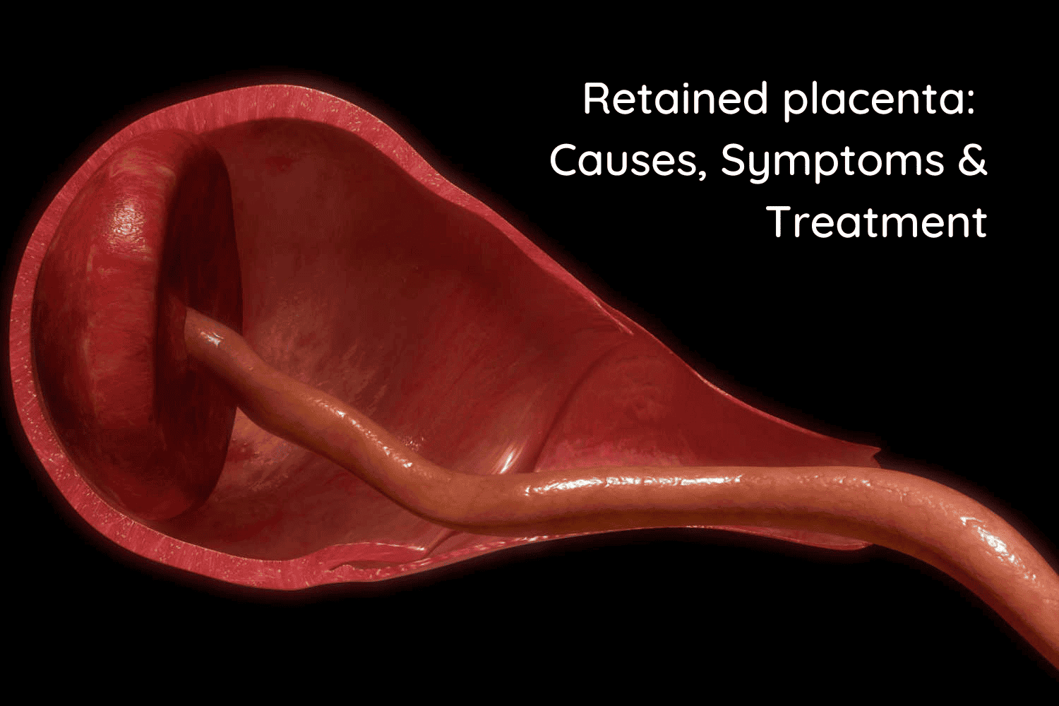 Retained Placental Fragments