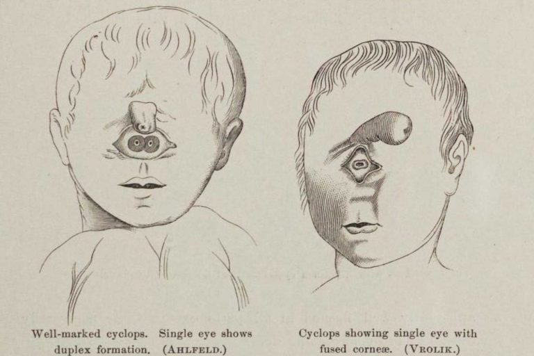 Cyclopia in Babies - What is it , Symptoms and Risk Factors