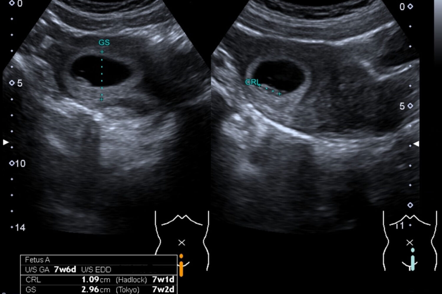 Crown Rump Length CRL In Pregnancy