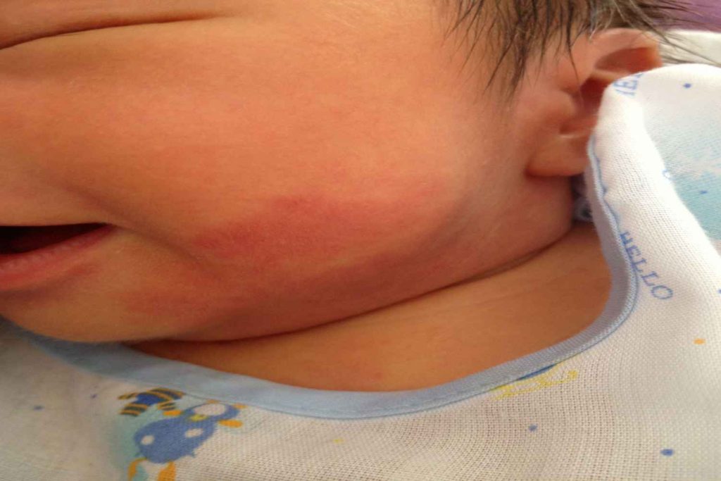 Port Wine Stain Birthmarks in Babies - Causes & Treatment