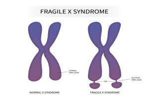 Fragile X Syndrome in Children - Diagnosis and Treatment