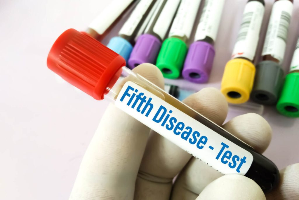 Fifth Disease in Children - What is it, Symptoms and Tips to Preven