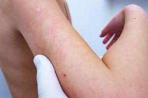 Fifth Disease in Children - What is it, Symptoms and Tips to Preven