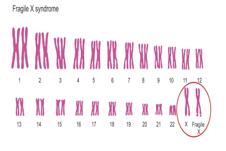 Fragile X Syndrome in Children - Diagnosis and Treatment
