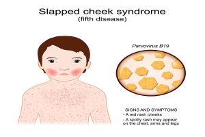 Fifth Disease in Children - What is it, Symptoms and Tips to Preven