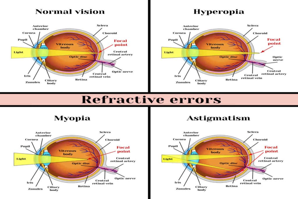 Refractive Eye Problems in Young Children - Ways to Prevent