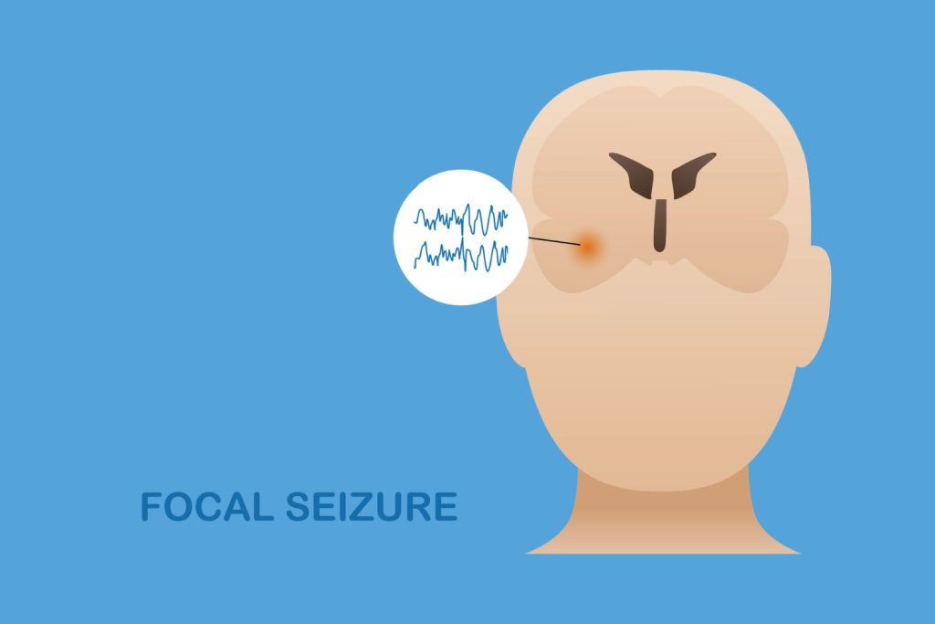 Temporal Lobe Epilepsy in Toddlers - Diagnosis and Treatment